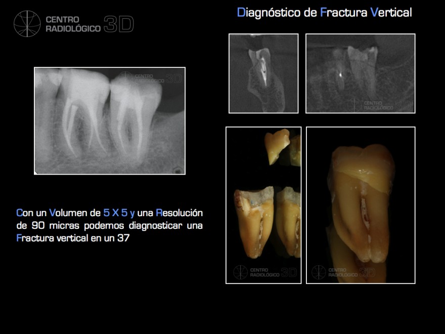 Centro Radiológico 3DDiagnóstico de una fractura vertical. Vol 5 x 5 ...